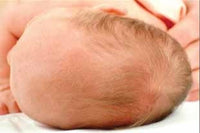 What parent should know about Dolichocephaly - Halo-Care