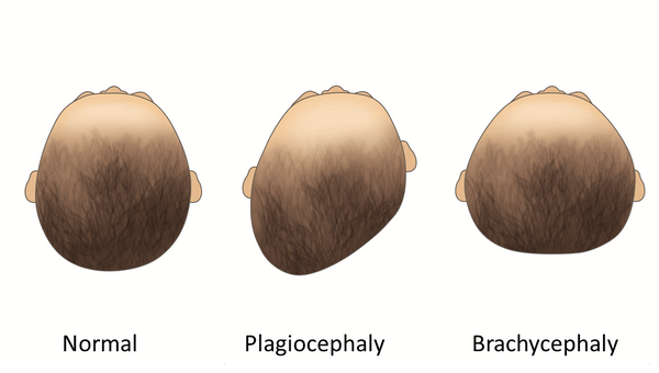 Plagiocephaly